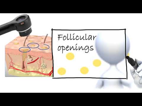 Trichoscopy for beginners (basic hair structures) 2020