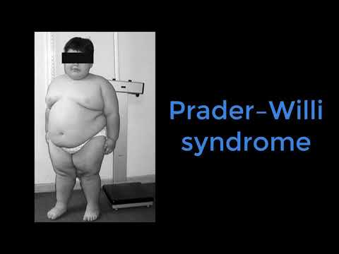 Prader–Willi syndrome