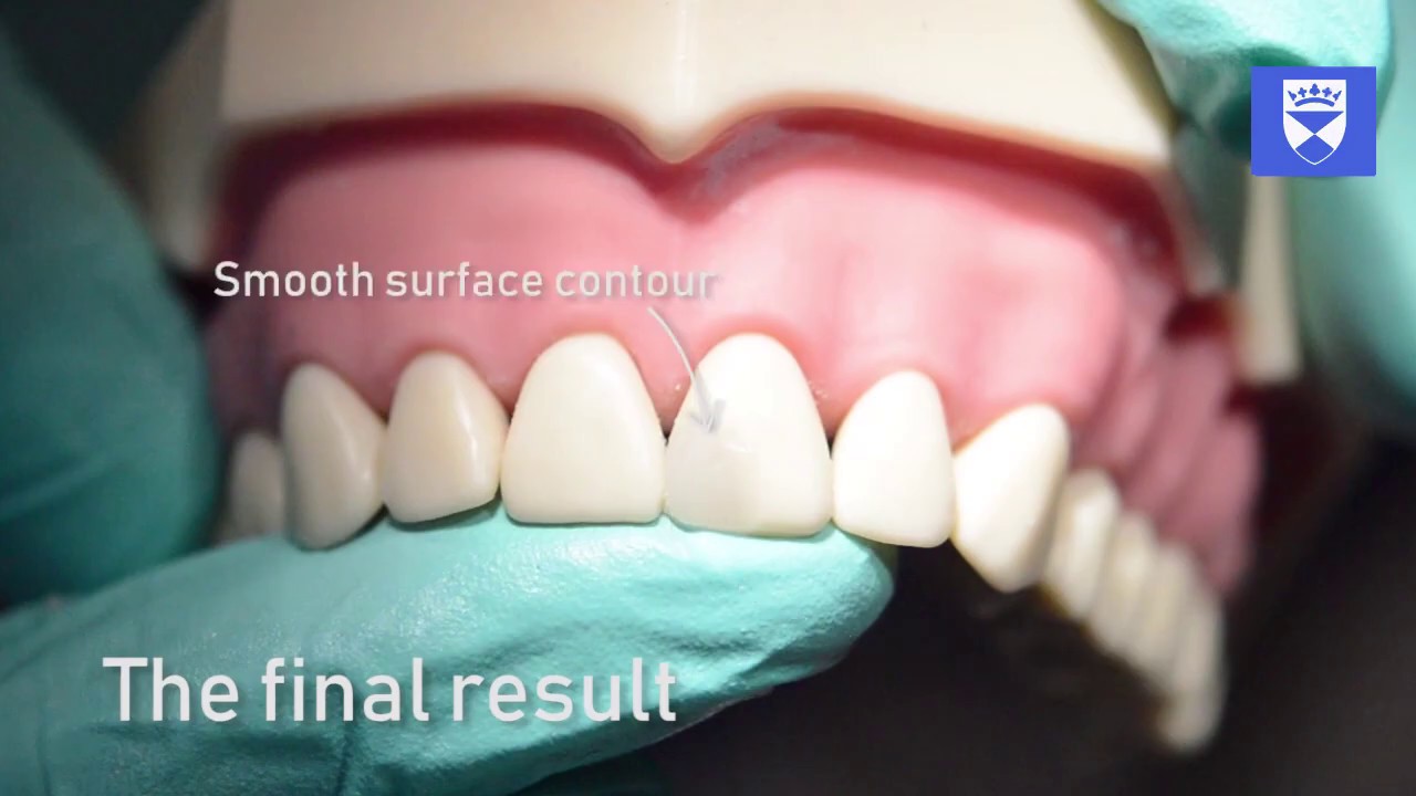 The direct anterior composite restoration