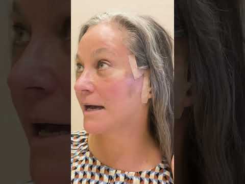 The outcome is breathtaking! #plasticsurgeryinkorea #beforeandafter #braunps #mommymakeover