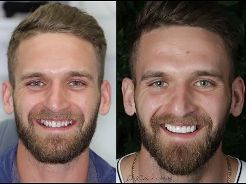 🔥 OVERBITE New Smile Makeover vol. 26 with Dr Richard Deep Bite No Orthodontics Smile Makeover