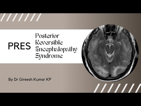 PRES || Posterior Reversible Encephalopathy Syndrome