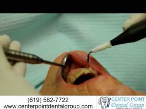 Laser Dentistry San Diego | High Tech Dentist San Diego | Modern Dentistry in (619)582-7722