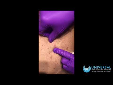 Dilated Pore of Winer | Universal Dermatology & Vein Care