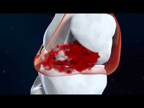 Bleeds into joints – Haemophilia Scotland