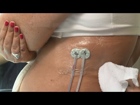 How to care for post-surgery wound drainage system and Biopatch dressing