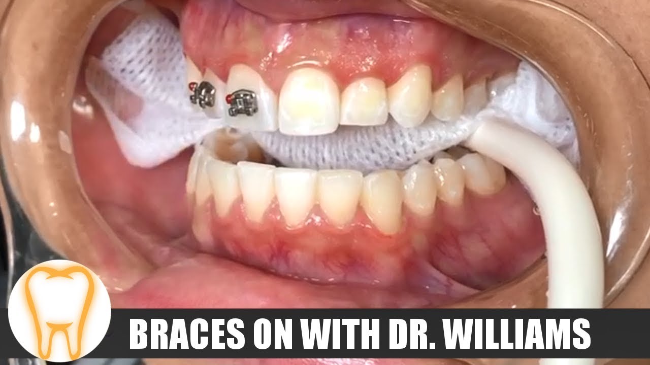 Tooth Time New Braunfels - How you get your Braces Step by Step