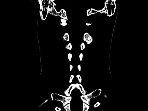 CT scan of the spine, front to back