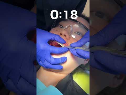 Let’s see how fast our registered dental assistant can take a wire out #braces #smile #bracesjourney