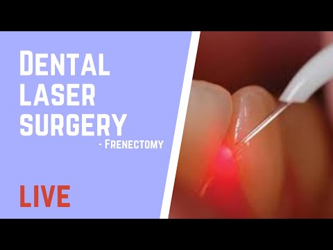 🆕dental Laser Surgery Laser Gum Treatment Video step by step