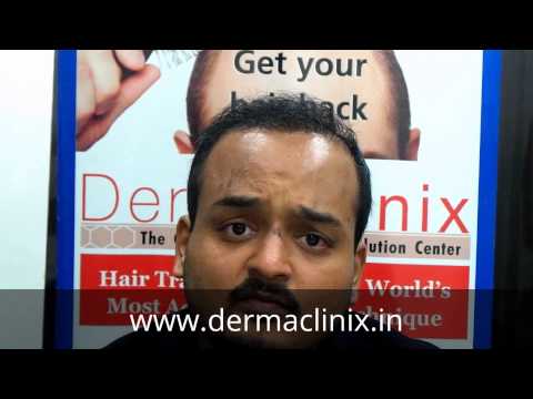 FUE HAIR TRANSPLANT IN Grade 7 baldness at DERMACLINIX, Delhi, INDIA by Dr.Kavish