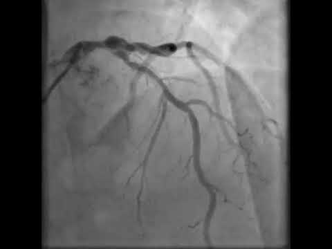 LAD Coronary Stenosis
