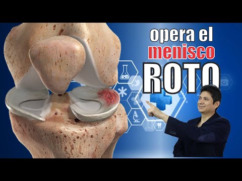 Rotura de MENISCOS ???????? Cirugía ARTROSCÓPICA de RODILLA ⭐ Dr WALTER ALVARADO Traumatología 24 hrs