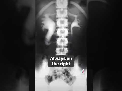 Retrocaval (aka: Circumcaval) ureter