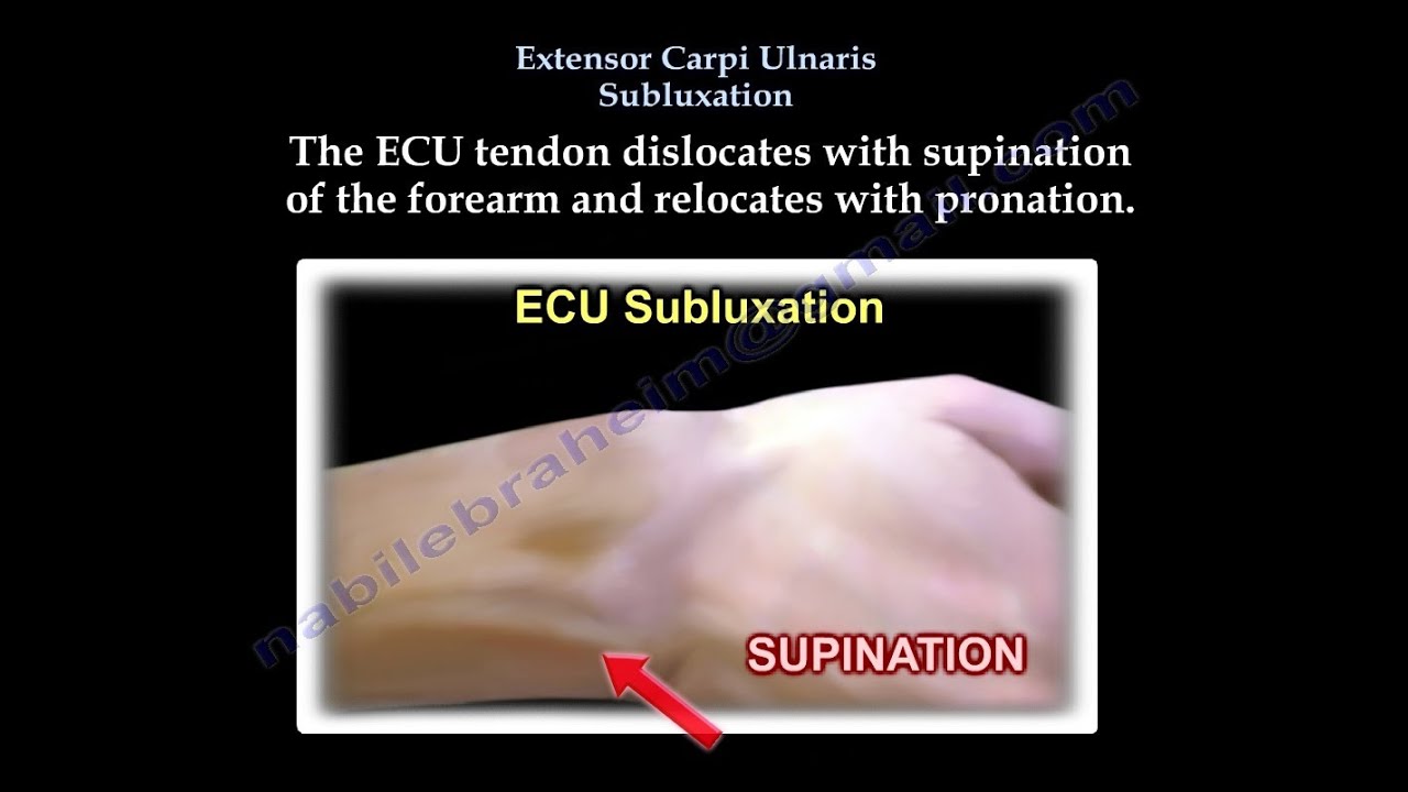 Extensor Carpi Ulnaris Subluxation - Everything You Need To Know - Dr. Nabil Ebraheim