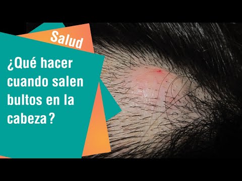 ¿Qué hacer cuando salen bultos duros en la cabeza? | Salud