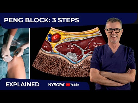 PENG block (NYSORA) – POCUS Academy