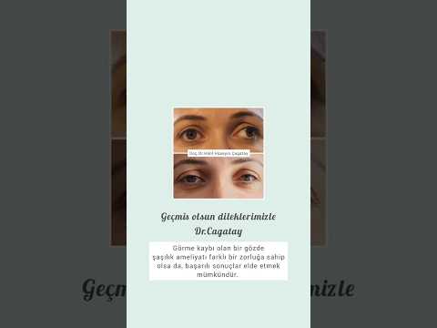 Lazy Eye Strabismus Surgery #squint #ลaลฤฑlฤฑktedavisi #eyes
