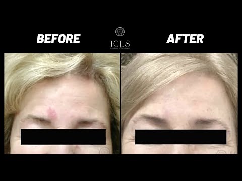 Basal Cell Carcinoma (BCC) | What is BCC & it's Treatment | ICLS Dermatology & Plastic Surgery