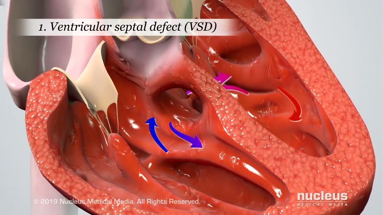 Blue Baby Heart Defect: Tetralogy of Fallot