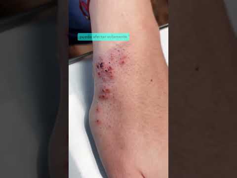 Cómo disminuir 🤩 síntomas y compilaciones del hérpes zoster 😅 dermatólogo reacciona y explica