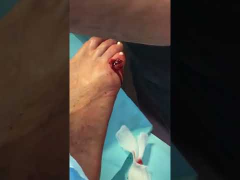 Arthroplasty (Hammertoe Correction)