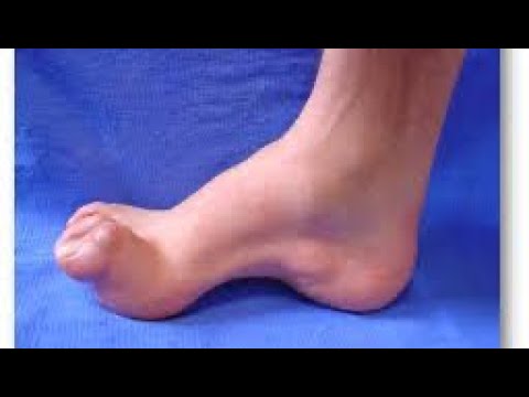 What is CMT or  Charcot Marie Tooth disease?