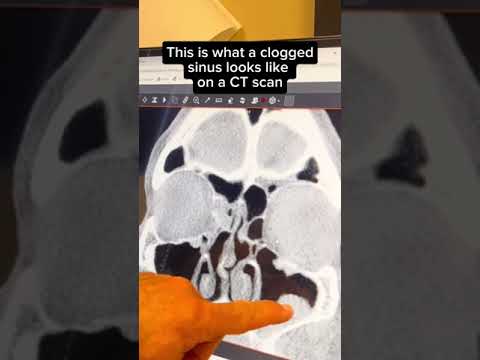 What a clogged sinus looks like on a CT scan