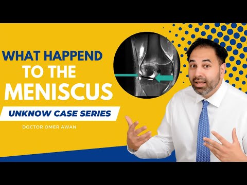 The Radiology of Rare Knee Conditions: Discoid Meniscus | Dr omer Awan