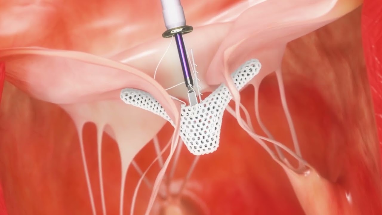 Tricuspid Valve Repair with TriClip™ | Deborah Heart & Lung Center