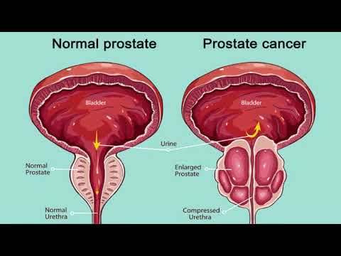 Prostate Problems in Elderly Men