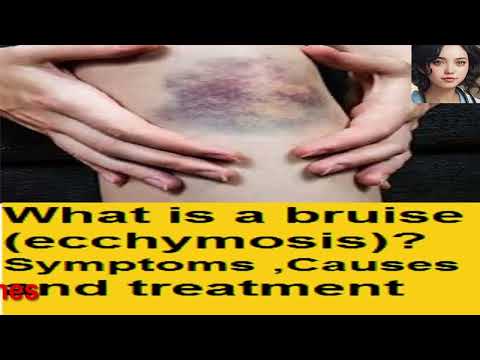 What is a bruise ecchymosis Symptoms , Causes and treatment