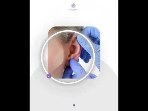 Otoplastia La cirugia de las orejas ¿Te molestan tus orejas?