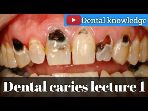 what is Dental caries lecture 1 in Urdu Hindi || by Dr khubaib Ahmed