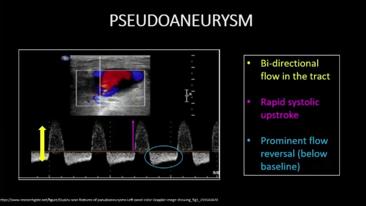 Peripheral Artery Ultrasound Interpretation | 15 Minute Radiology CME
