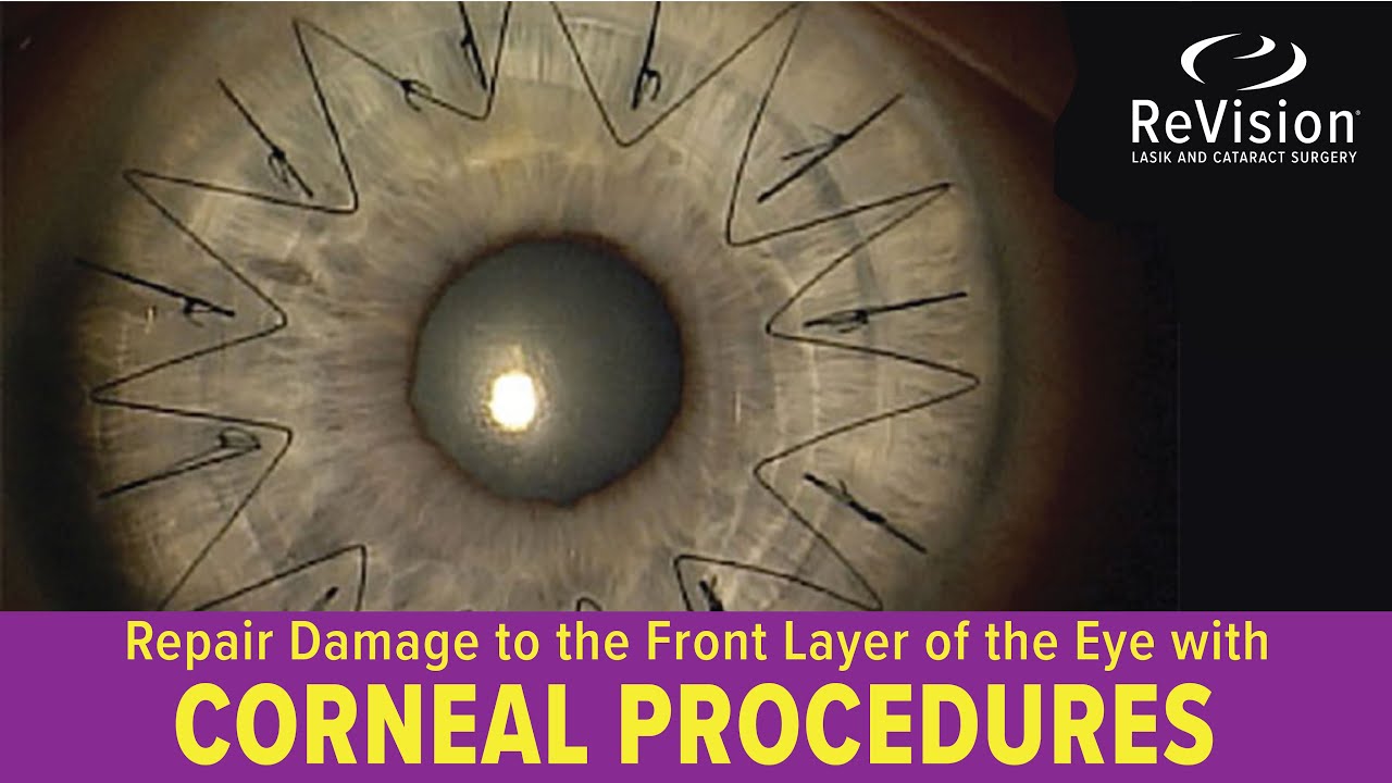 Corneal Procedures