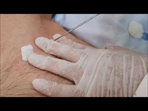 left supraclavicular lymph node met colon adenoca