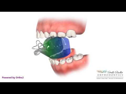 Bionator - Orthodontic Treatment - Deep Bite - Overjet