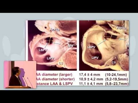 LAA-anatomy: landmarks and morphologies. What is important to know for LAA Occlusion?