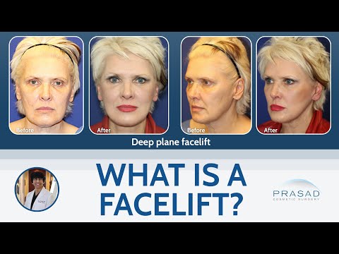 What is a Facelift?