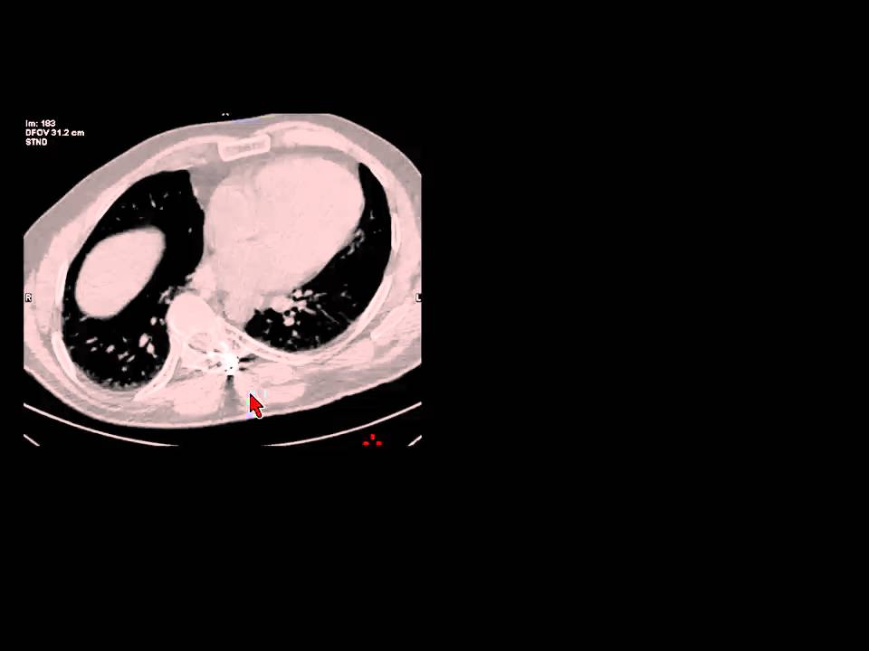 06 SPECT CT of post operative spine