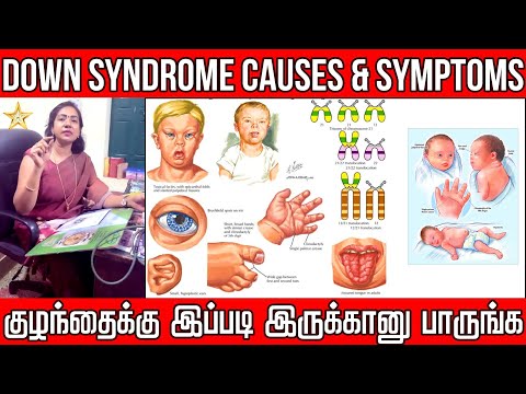 Down Syndrome Causes Symptoms and Treatment in Tamil | Asha Lenin