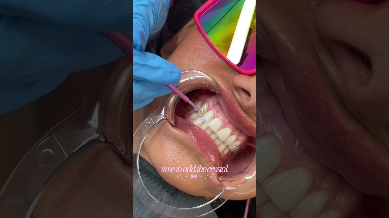 the tooth gem process 🦷💎 #toothgems  #torontotoothgems