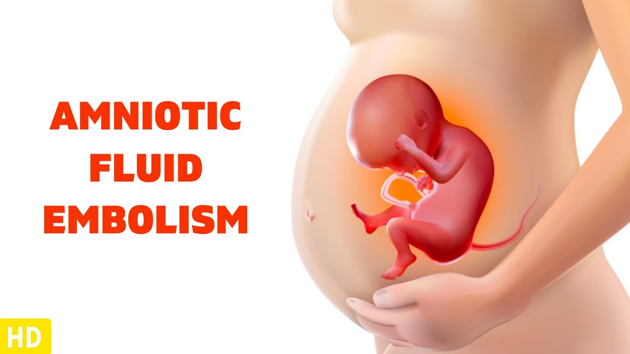 Amniotic Fluid Embolism: The Silent Threat During Childbirth