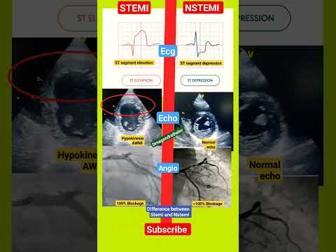 Difference between STEMI ( Heart attack)💔 and NSTEMI by ECG, ECHO, ANGIOGRAPHY #echo #shorts