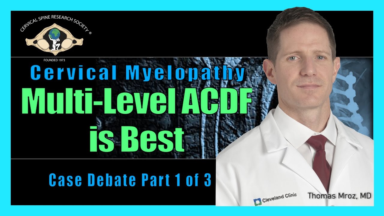 Cervical Myelopathy: Multi-Level ACDF  Case Debate 1 of 3 - Dr. Thomas Mroz