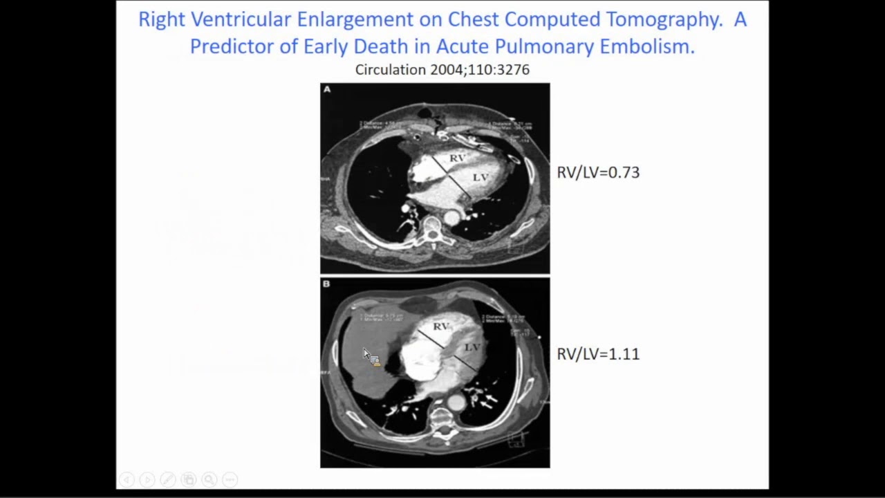 Advances in the Management of Pulmonary Embolism, From Early Discharge to Advanced Therapies
