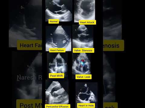 Normal Echo vs Abnormal Echo | Heart Attack | Naresh Rathod #heartattack #humanheart