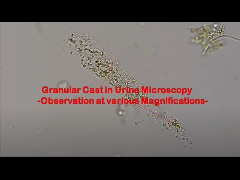 Granular Cast in Urine Microscopy at at magnifications