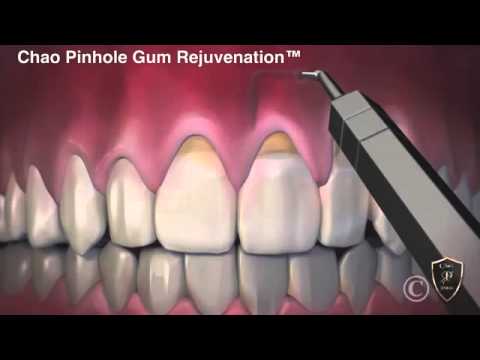 Dr. Penhaskashi Shares Gum Grafting vs Chao Pinhole Surgical Technique in Encino CA